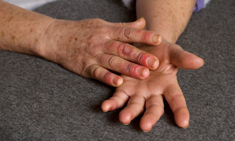 Tratamento para o fenômeno de Raynaud - Dr. Marcelo Pavan