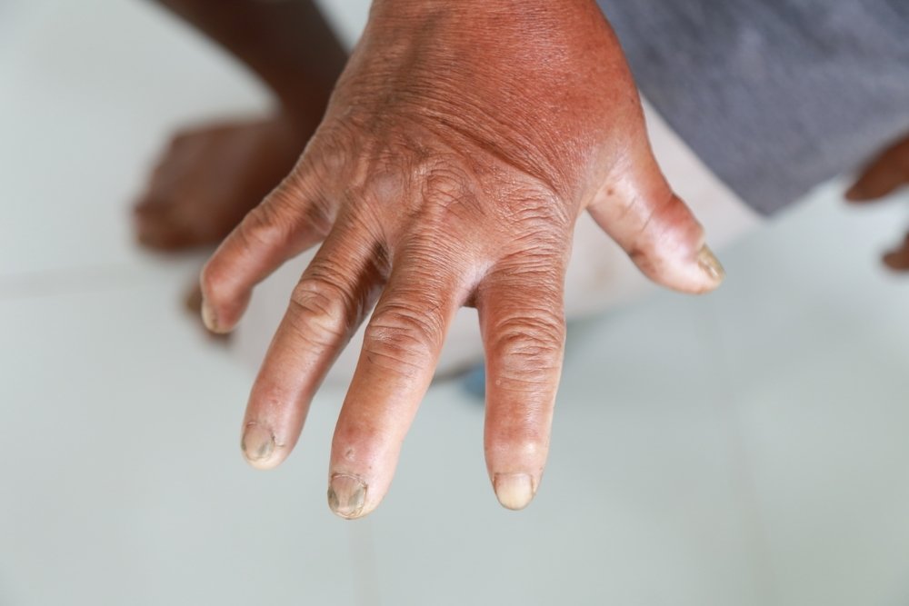 Esclerodermia localizada: causas, sintomas, diagnóstico e tratamento